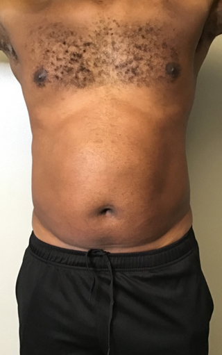 PHYSIQ 360: Multi-Modality Body Contouring Solution