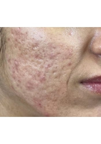 Tetra PRO with CoolPeel - A Highly Versatile Laser Skin Resurfacing Device