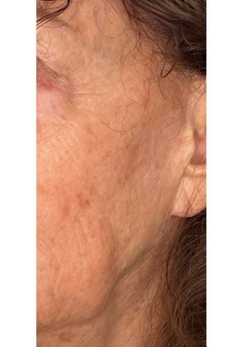 EVERESSE: Non-Invasive Monopolar RF Device