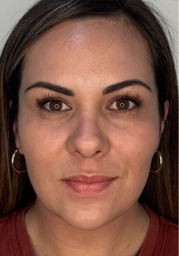 EVERESSE: Non-Invasive Monopolar RF Device