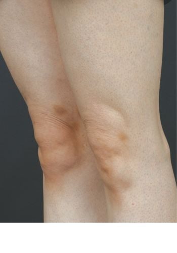 EVERESSE: Non-Invasive Monopolar RF Device