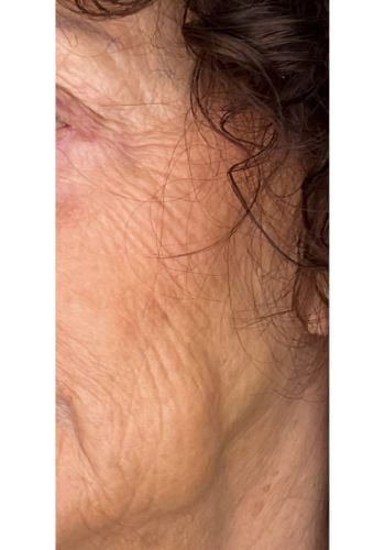 EVERESSE: Non-Invasive Monopolar RF Device