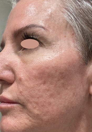 HELIX - Customizable CO2 + 1570nm Skin Resurfacing