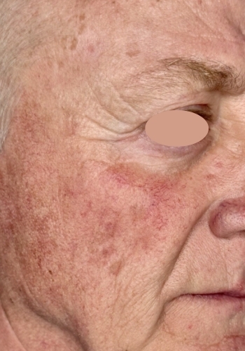Tetra PRO with CoolPeel - A Highly Versatile Laser Skin Resurfacing Device