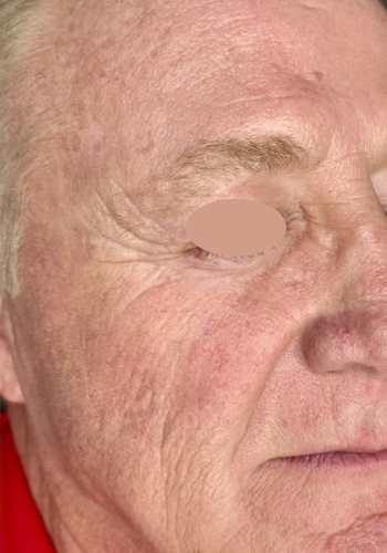 Tetra PRO with CoolPeel - A Highly Versatile Laser Skin Resurfacing Device